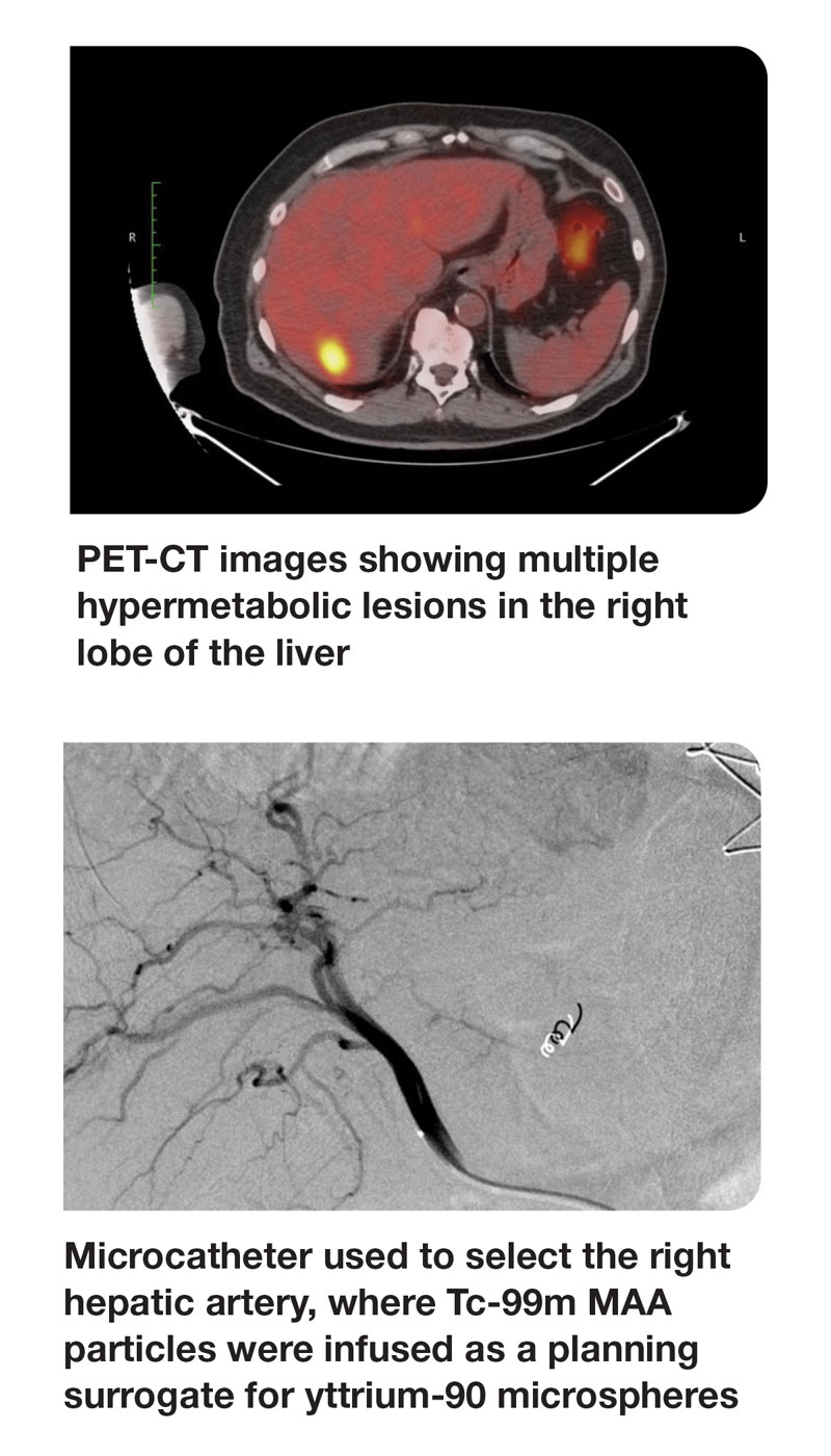 Y-90 SIRT Case Study - Synergy Vascular and Interventional Radiology