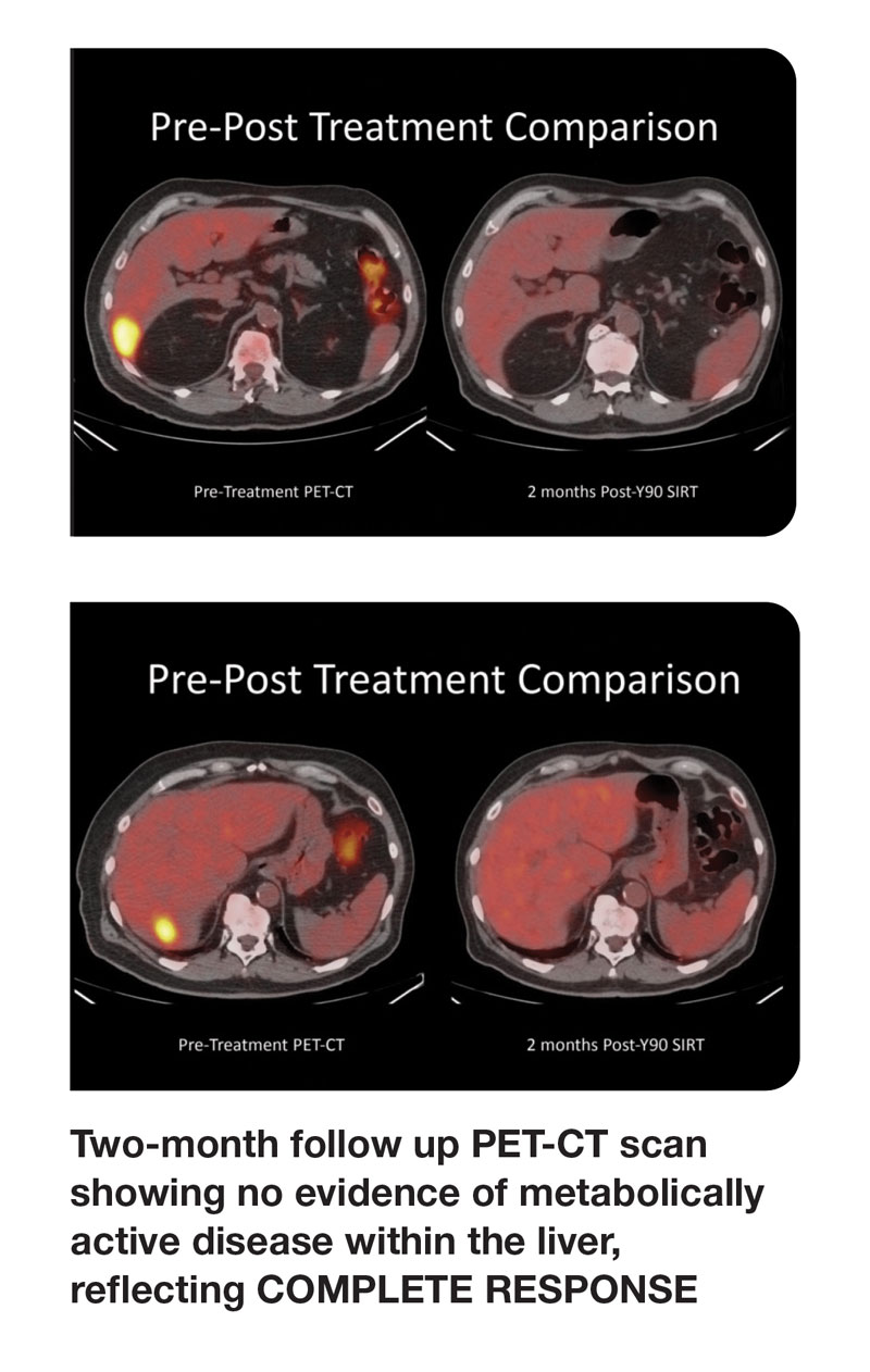 Y-90 SIRT Case Study - Synergy Vascular and Interventional Radiology
